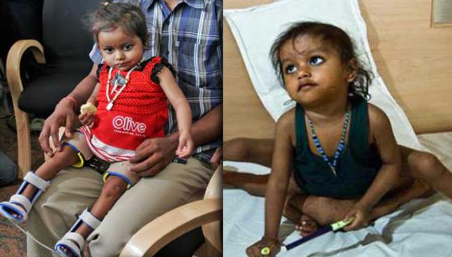 Baby with eight limbs gets new lease on life in India | FMT