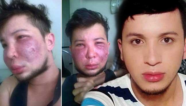 Muka reput, busuk, bernanah akibat doktor kosmetik palsu | Free ...