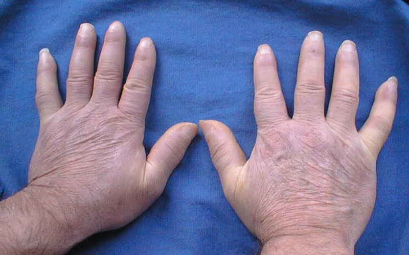 Scleroderma: shedding light on this rare autoimmune disease | FMT