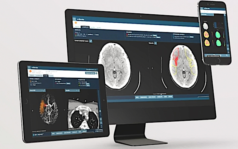 AI-powered tech ‘sees big improvements in UK stroke treatment’ | FMT