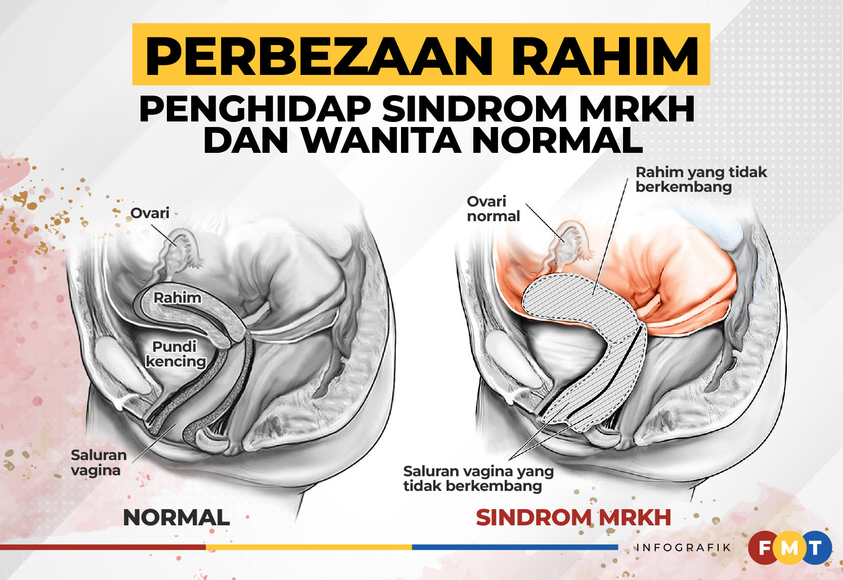 Sokongan suami kekuatan bantu wanita tanpa rahim, kata pengasas MRKH Malaysia | Free Malaysia ...